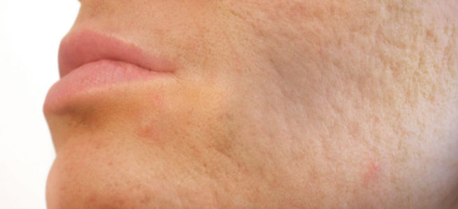 Aknenarben behandeln & entfernen | Pickel schnell weg